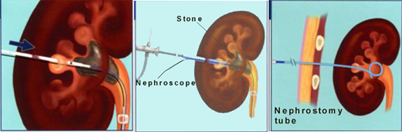 Percutaneous Nephrolithotomy PCNL - Chin Chong Min Urology